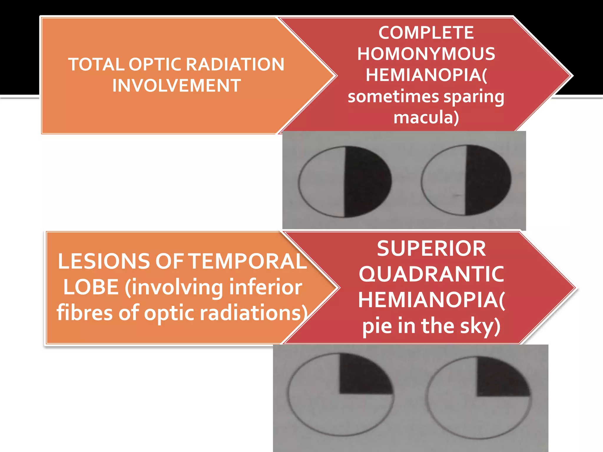 Visual pathway and its defects | PPTX