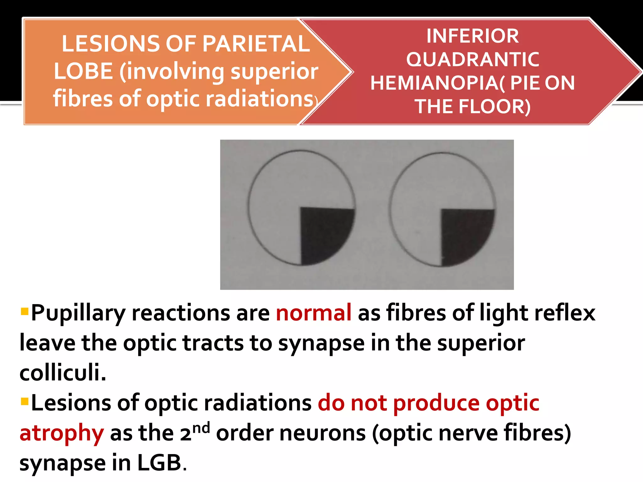 Visual pathway and its defects | PPTX