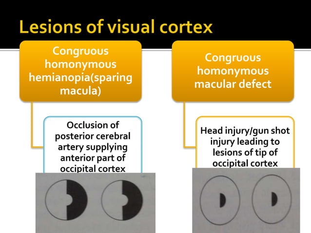 Visual pathway and its defects | PPTX