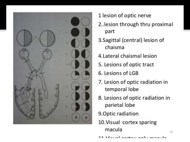 Visual pathway and its defects | PPT