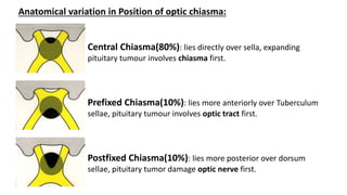 Visual pathway and lesion | PPTX