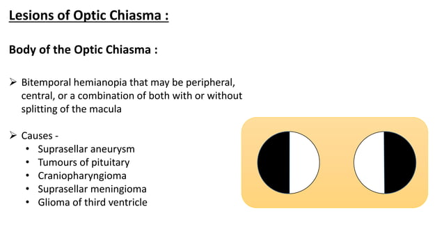 Visual pathway and lesion | PPTX