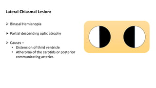Visual pathway and lesion | PPTX