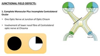 Visual pathway and lesion | PPTX