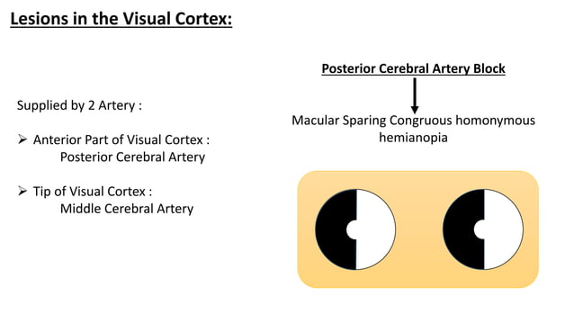 Visual pathway and lesion | PPTX