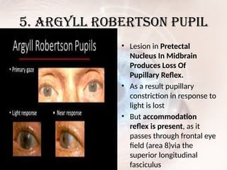 visual pathway diseases and clinical significance pptx | PPTX