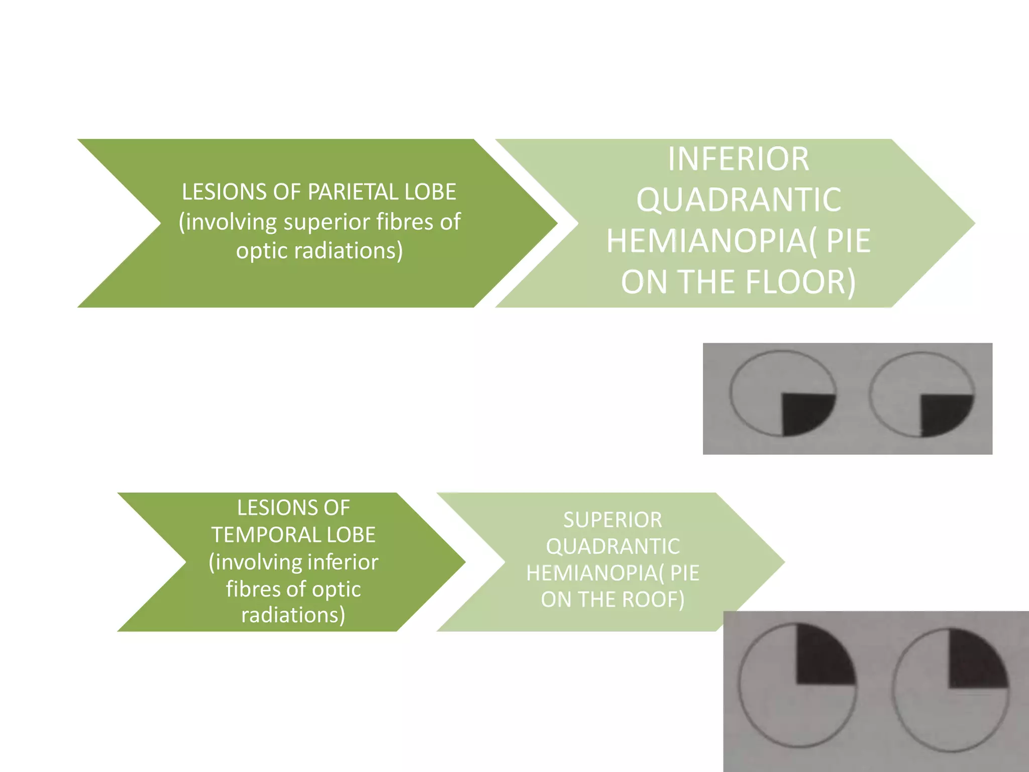 visual pathway & its lesions.pptx
