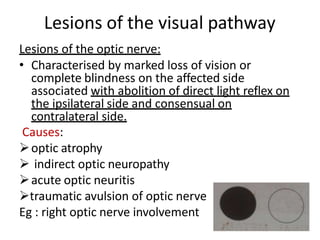 visual pathway & its lesions.pptx