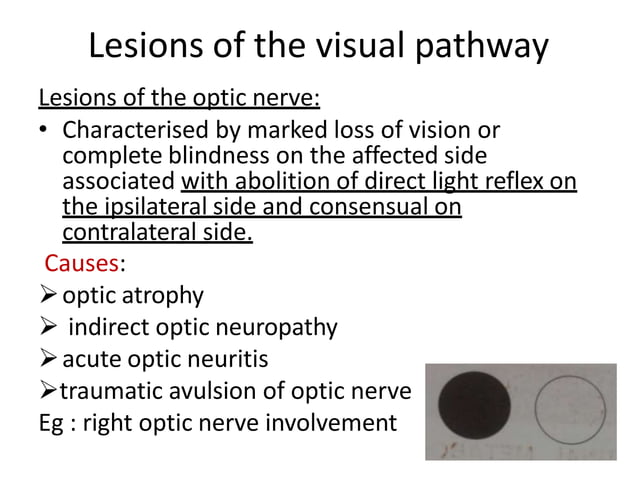 visual pathway & its lesions.pptx | Eye and Vision Conditions ...