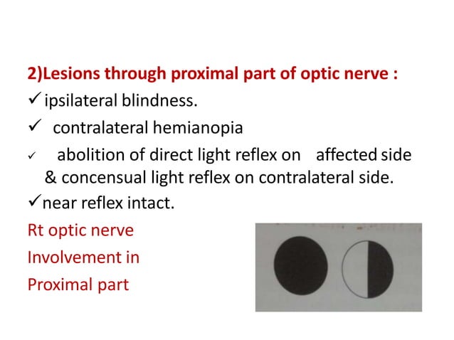 visual pathway & its lesions.pptx | Eye and Vision Conditions ...