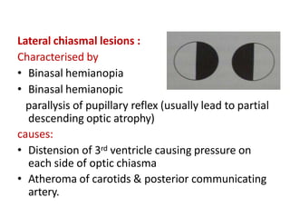 visual pathway & its lesions.pptx