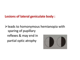 visual pathway & its lesions.pptx