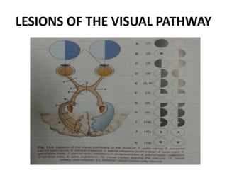 Visual pathway & optic nerve tumours | PPTX