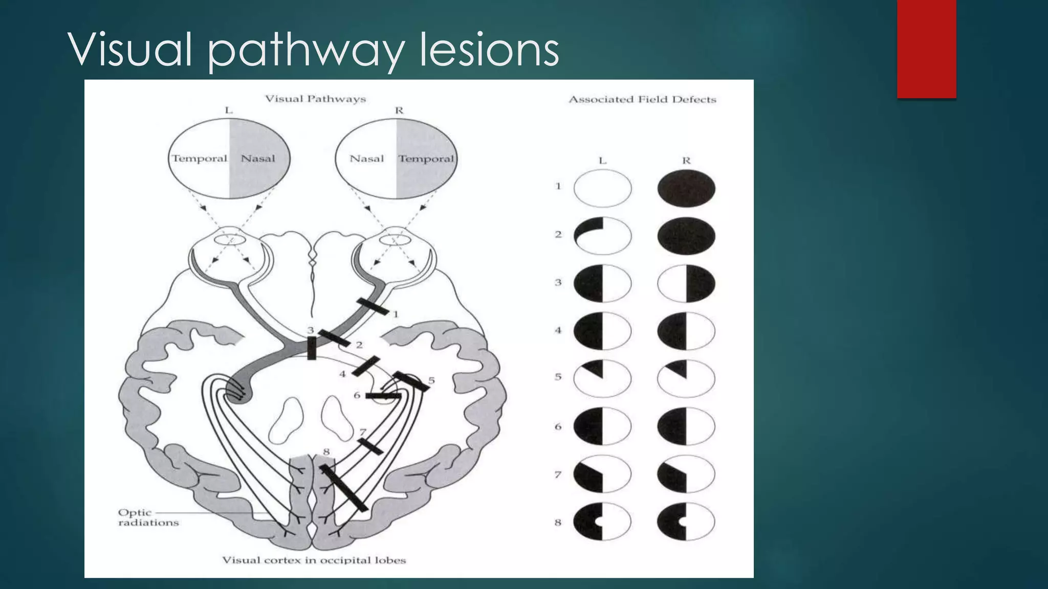 Visual pathways and optic nerve. | PPTX | Eye and Vision Conditions ...