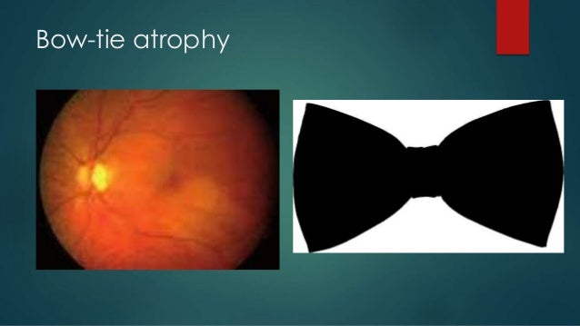 Visual pathways and optic nerve.