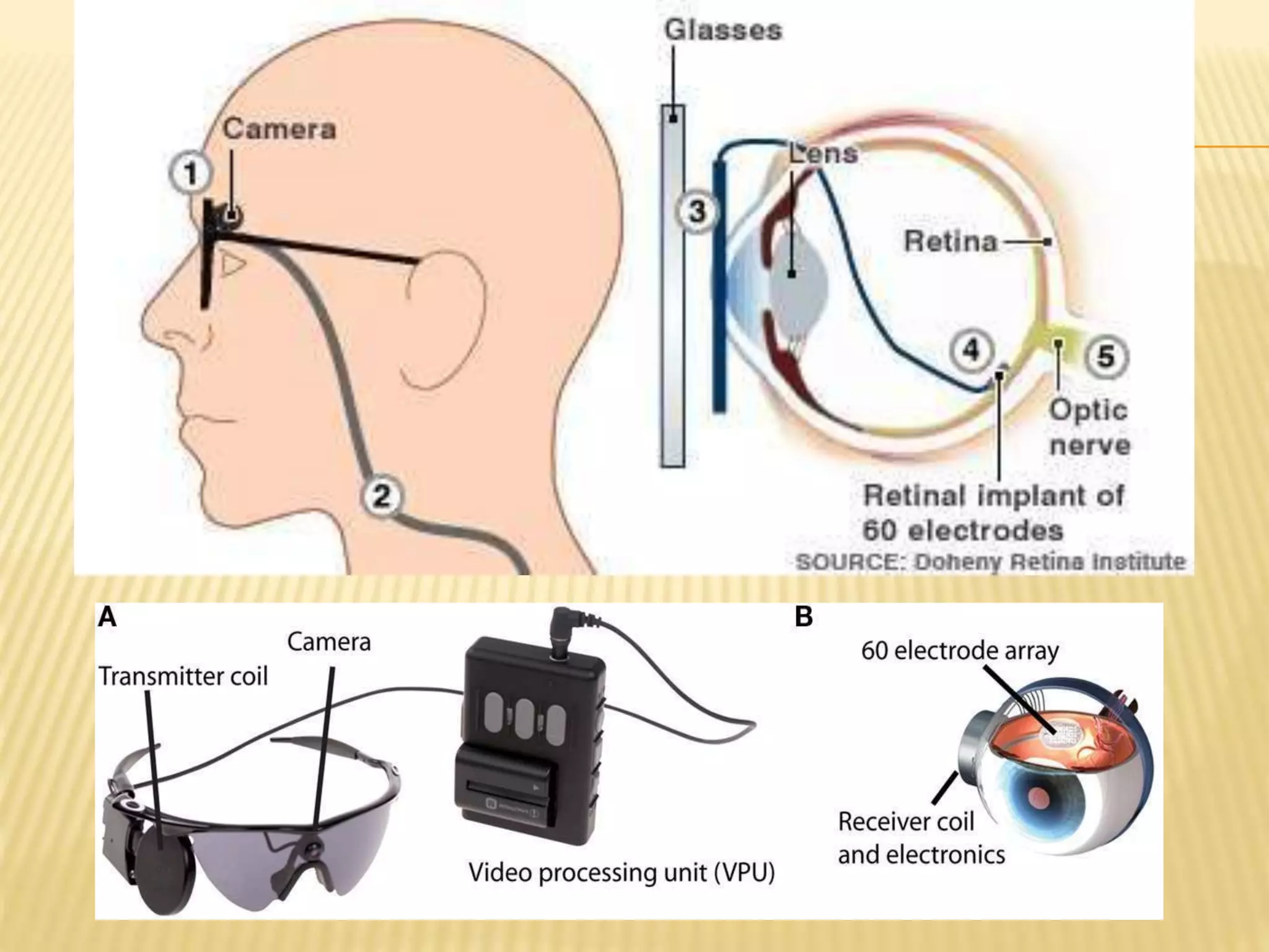 Visual prosthesis | PPTX