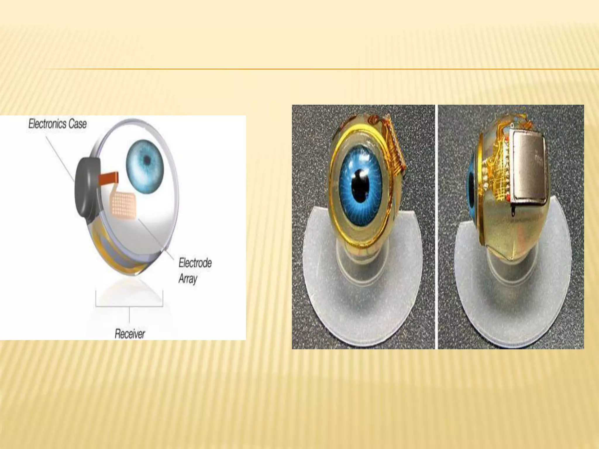 Visual prosthesis | PPTX