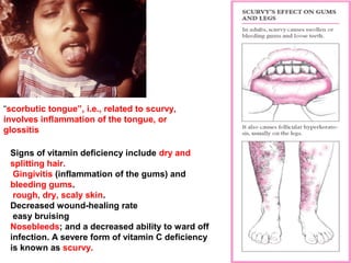 VITAMIN-C [MEDICINAL CHEMISTRY] SOURCE, RECOMMENDED DIETARY ALLOWANCE ...