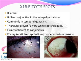 VITAMIN A & VISUAL CYCLE | PPT