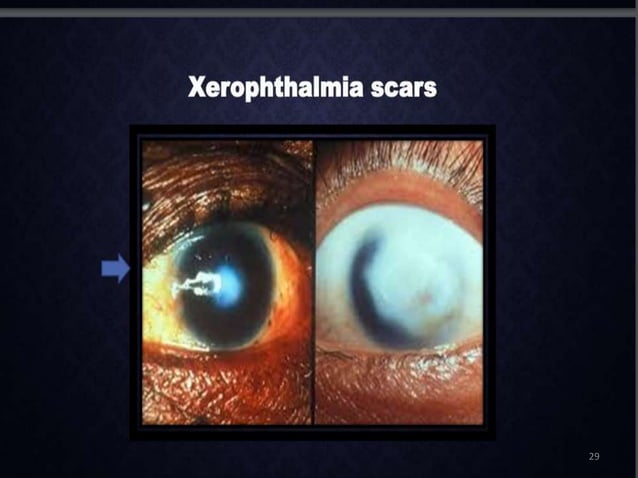 Vit a and vit a deficiency disorders | PPTX | Eye and Vision Conditions ...