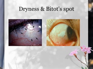 Vitamin A Deficiency | PPS