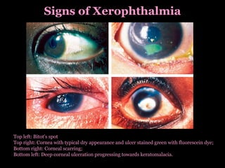 Vitamin A Deficiency | PPS