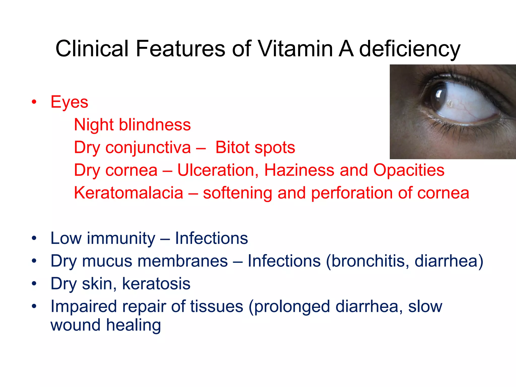 Vit a deficiency 2021 | PPT