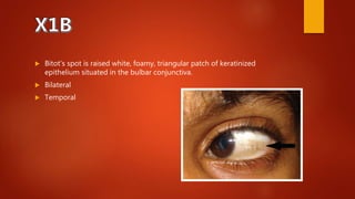 Vitamin A deficiency and prevention | PPTX