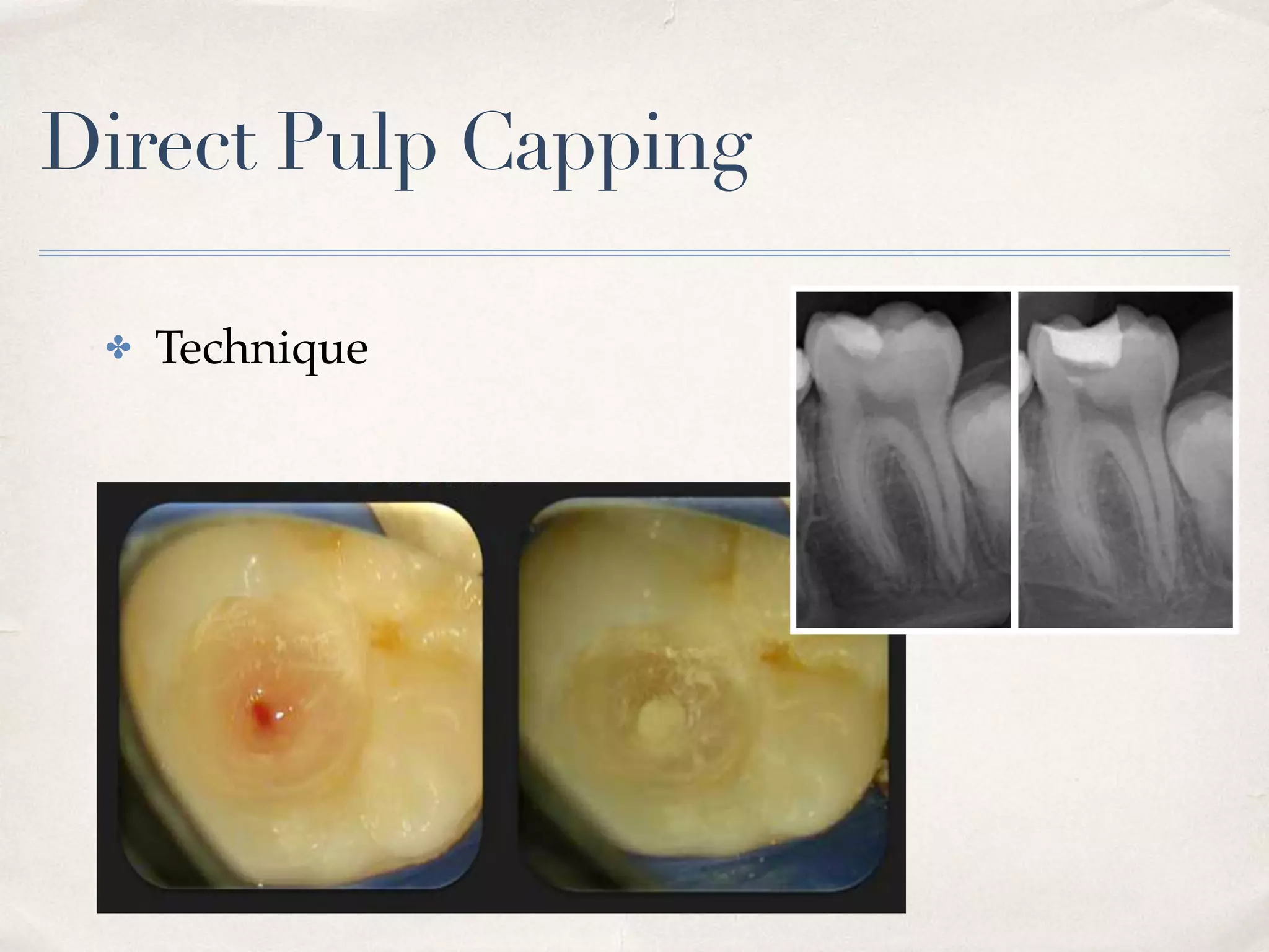 Vital pulp therapy | PDF