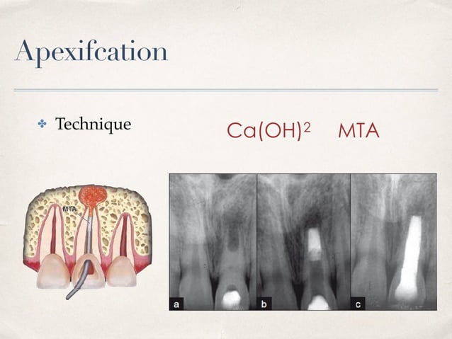 Vital pulp therapy | PPT