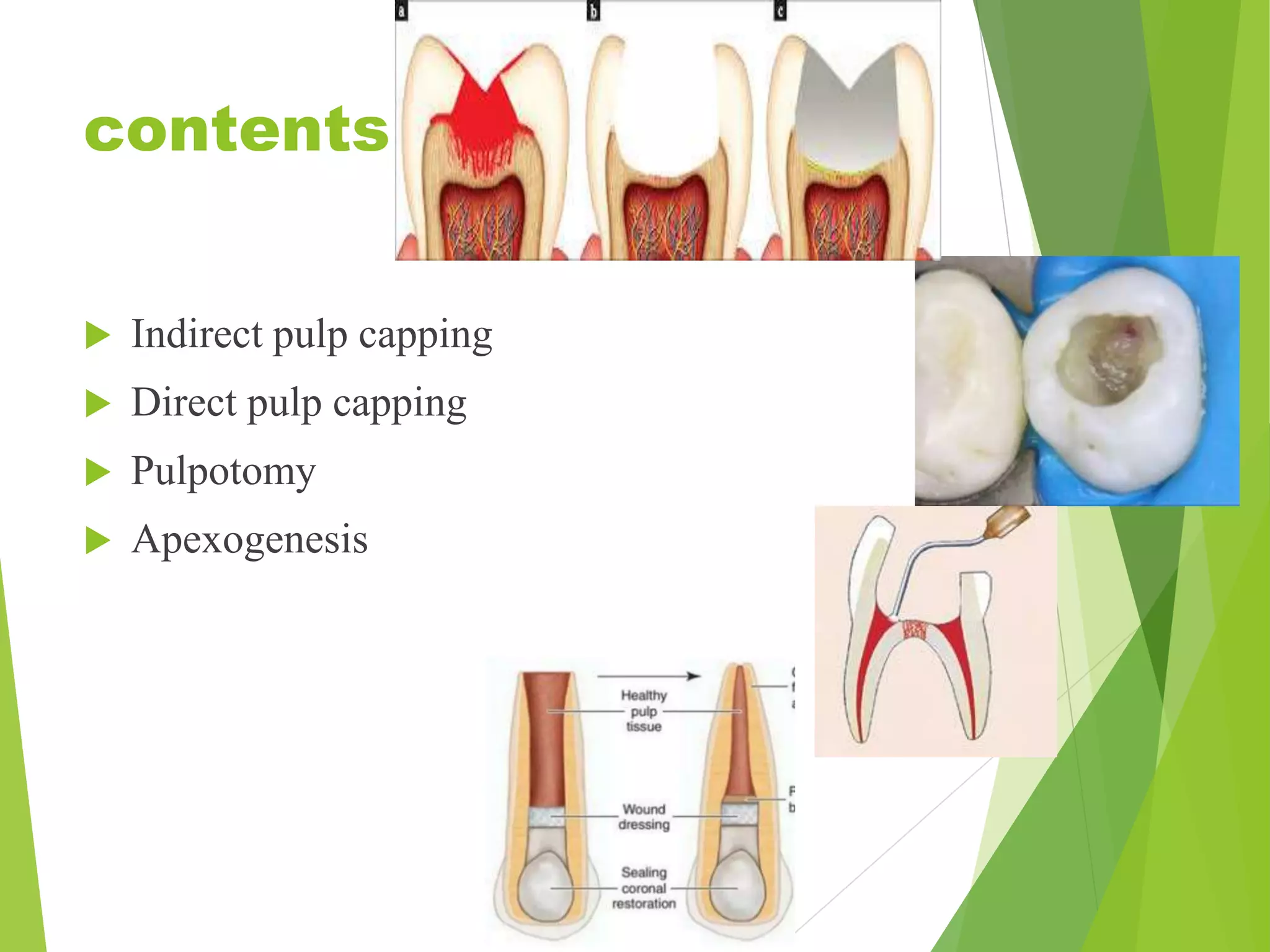 Vital pulp therapy | PPTX