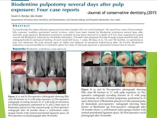 Vital pulp therapy | PPTX | Dental Health | Diseases and Conditions