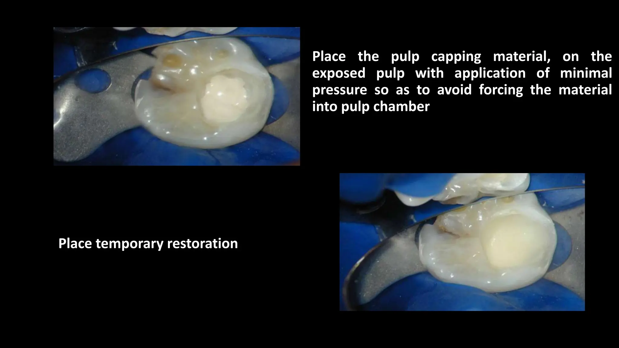vital pulp therapy.pptx | Dental Health | Diseases and Conditions