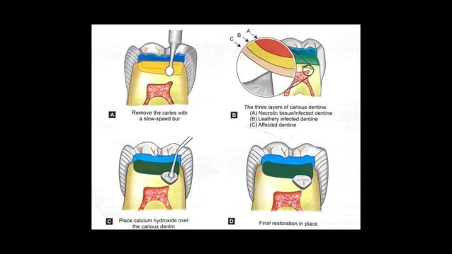 vital pulp therapy.pptx | Dental Health | Diseases and Conditions