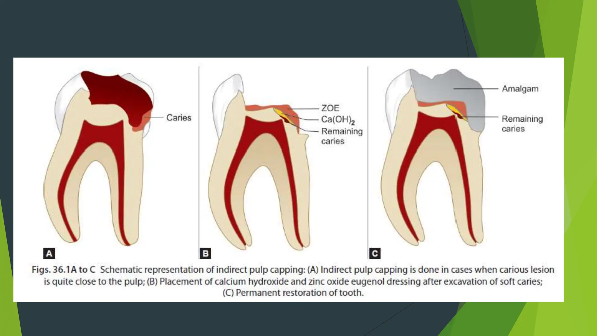 Vital Pulp Therapy.pptxVital Pulp Therapy.pptx