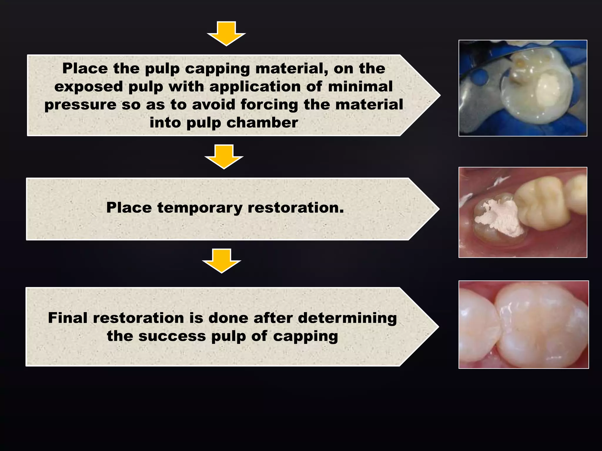 Vital pulp therapy in primary and permanent tooth | PPTX