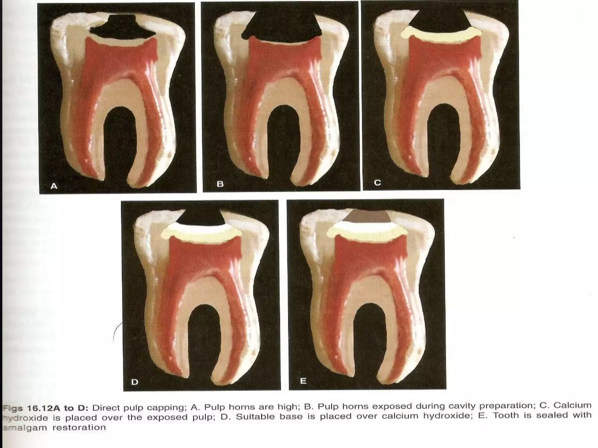 Vital pulp therapy in primary and permanent tooth | PPTX