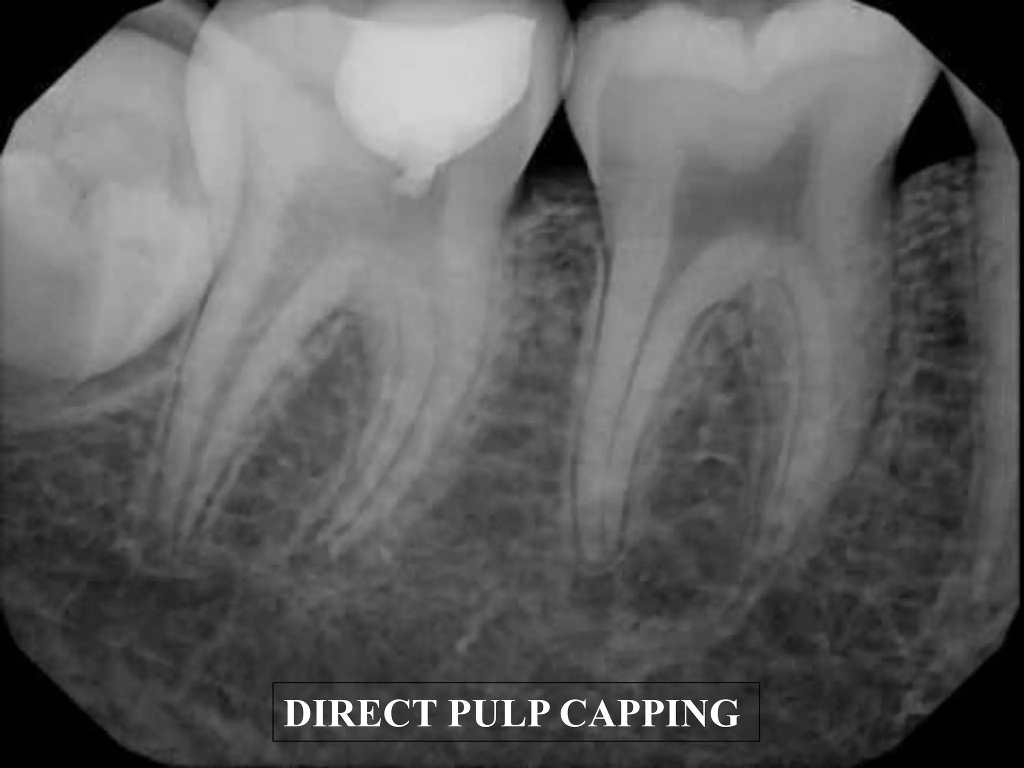 Vital pulp therapy in primary and permanent tooth | PPTX