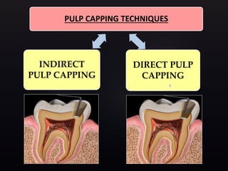 Vital pulp therapy in primary and permanent tooth | PPT