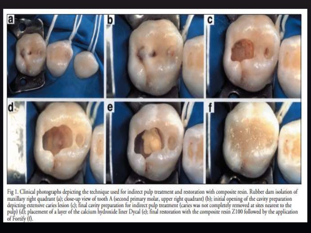 Vital pulp therapy in primary and permanent tooth