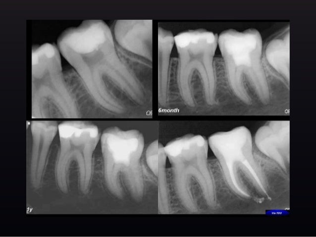 Vital pulp therapy in primary and permanent tooth