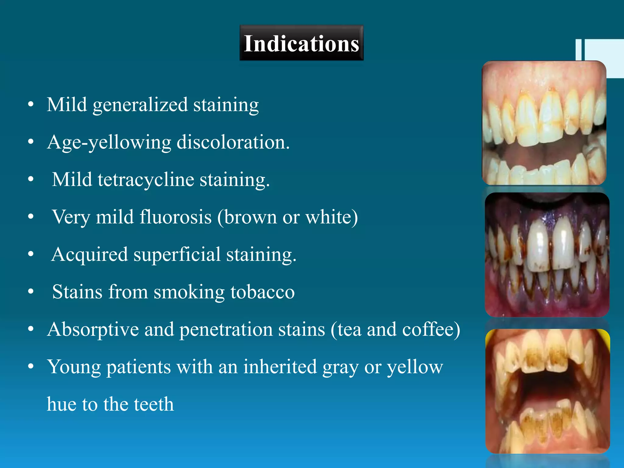 Vital tooth bleaching | PPTX