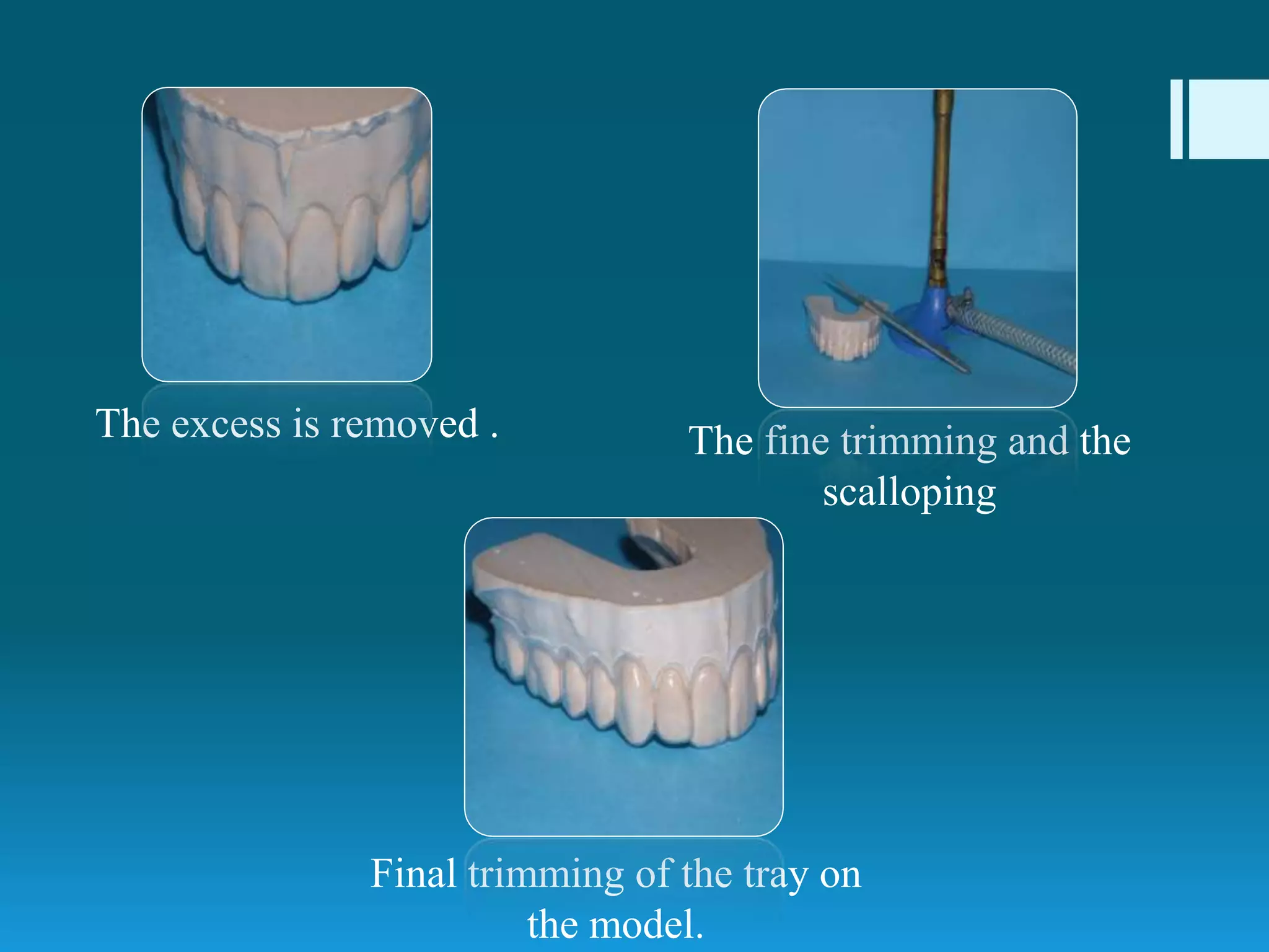 Vital tooth bleaching | PPTX