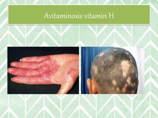 Vitamin | PPTX