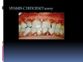Vitamin c deficiency scurvy | PPTX