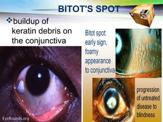 Vitamin a | PPT | Free Download