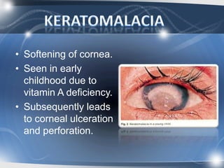Vitamin A deficiency and its impact on vision | PPTX
