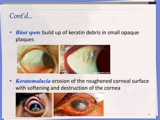 Vitamin A Deficiency | PPT