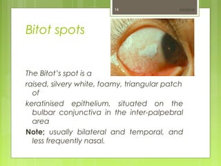 Vitamin a deficiency | PPT