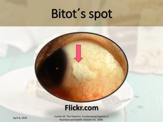 Vitamin A deficiency | PPSX